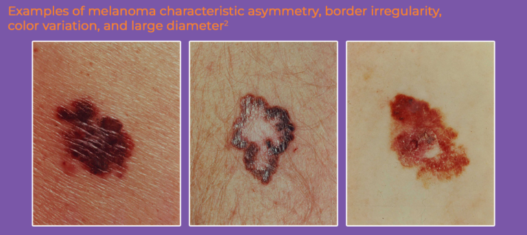 Diagnosis and Symptoms of Melanoma – ACTIVATE Melanoma