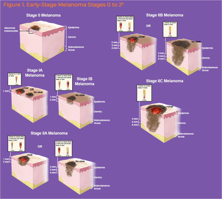 Treatment of Melanoma – ACTIVATE Melanoma